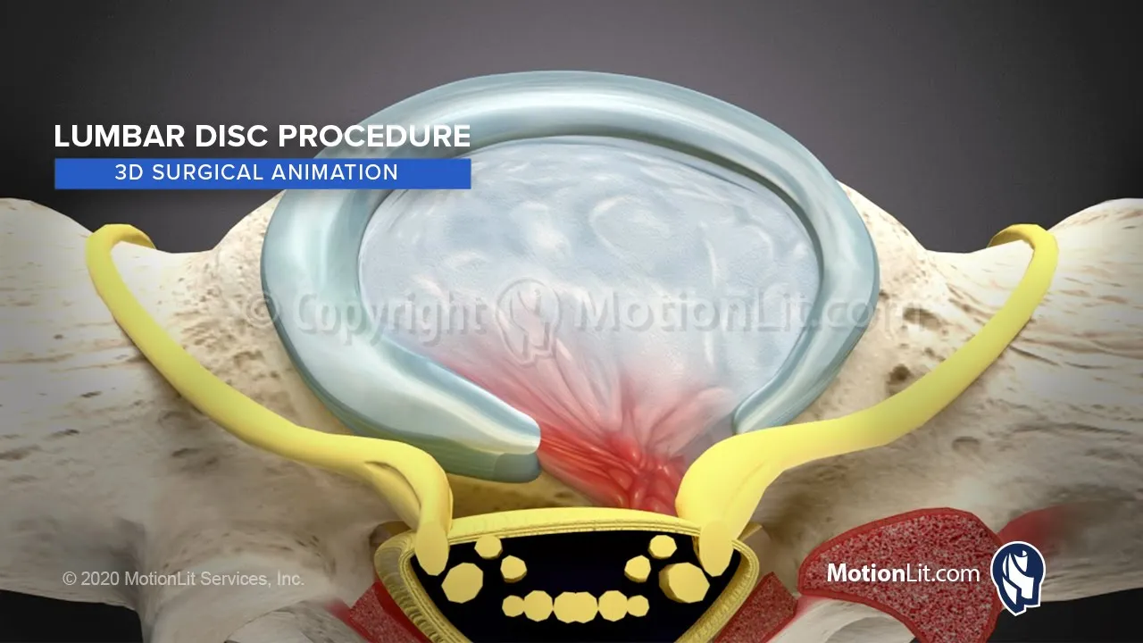 Medical Procedure Animation Visualizes Posterior Lumbar Microdiscectomy ...