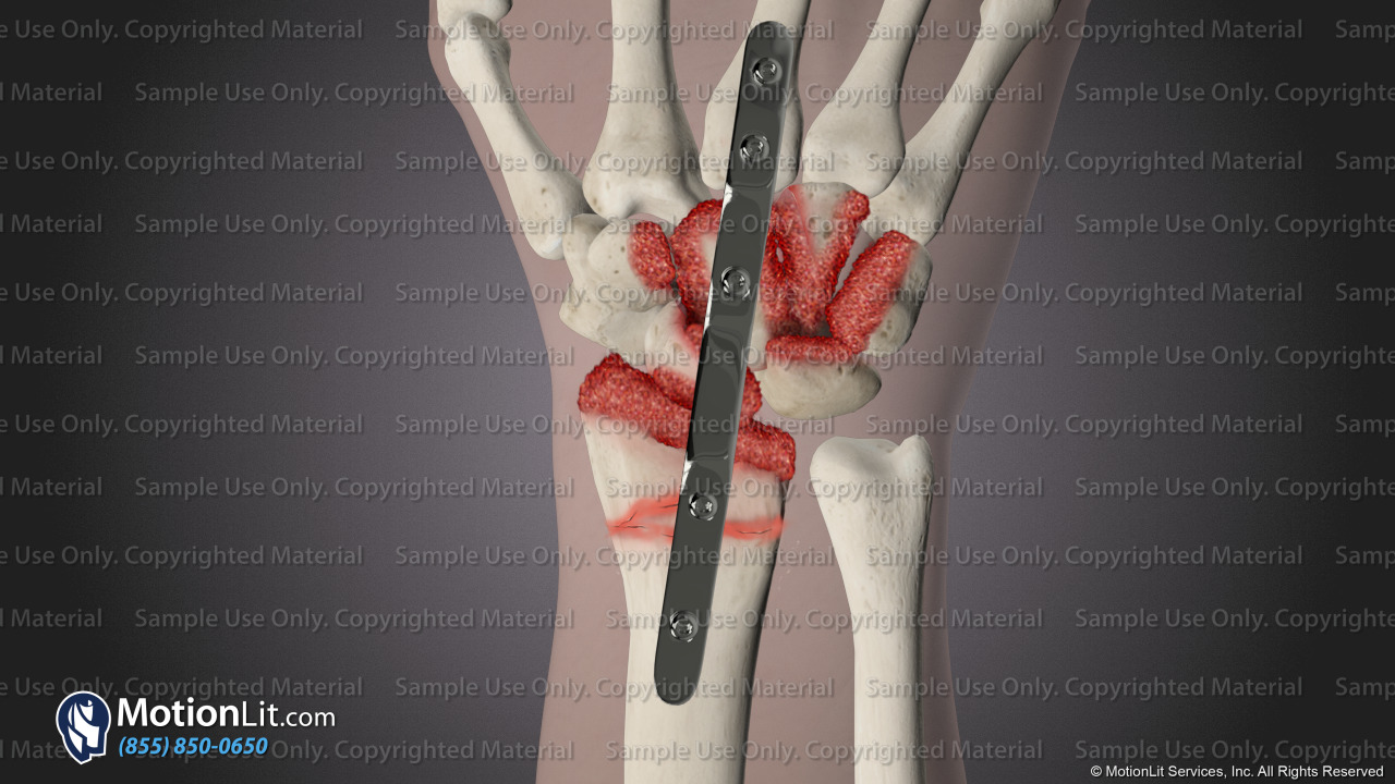 Wrist Fusion - MotionLit