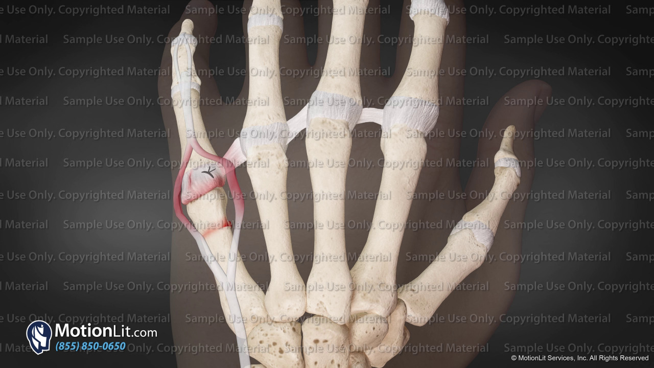 5th Metacarpal Malunion Repair - MotionLit
