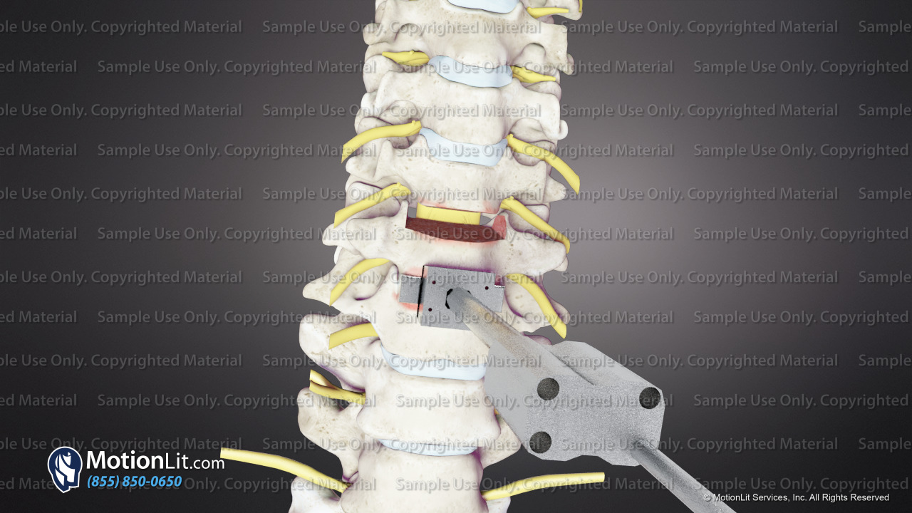 Cervical Arthroplasty & Disectomy C5-C7 - MotionLit