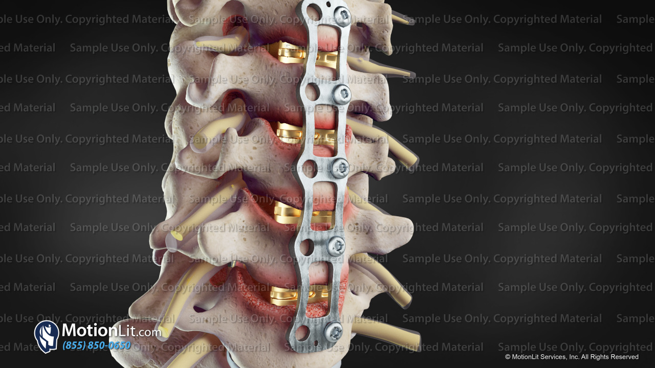 Anterior Cervical Disectomy & Decompression C3-C8 - MotionLit