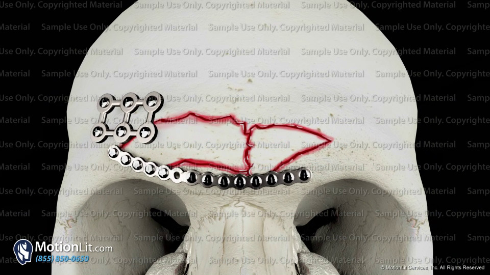 ORIF of Frontal Sinus - MotionLit