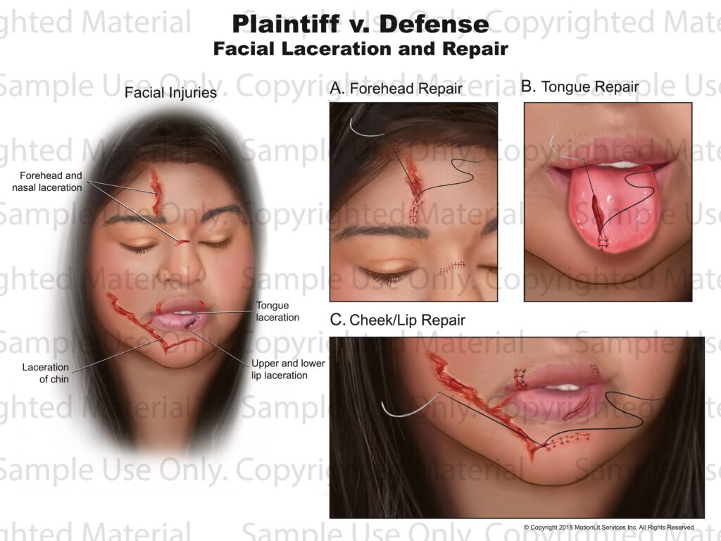 Facial Lacerations 1 - MotionLit