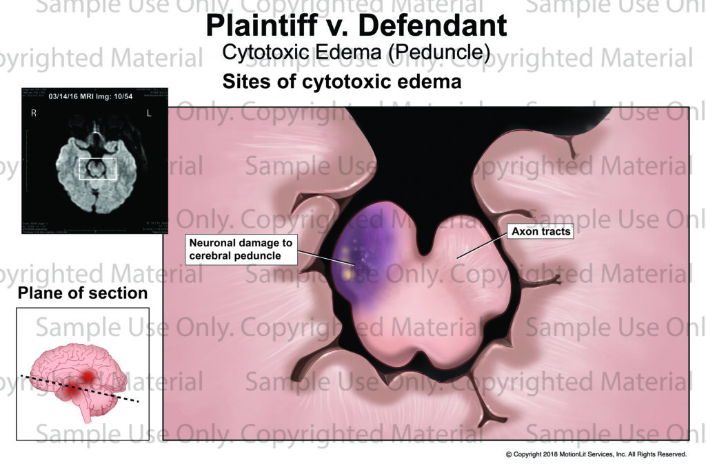 Cytotoxic Edema Peduncle - MotionLit