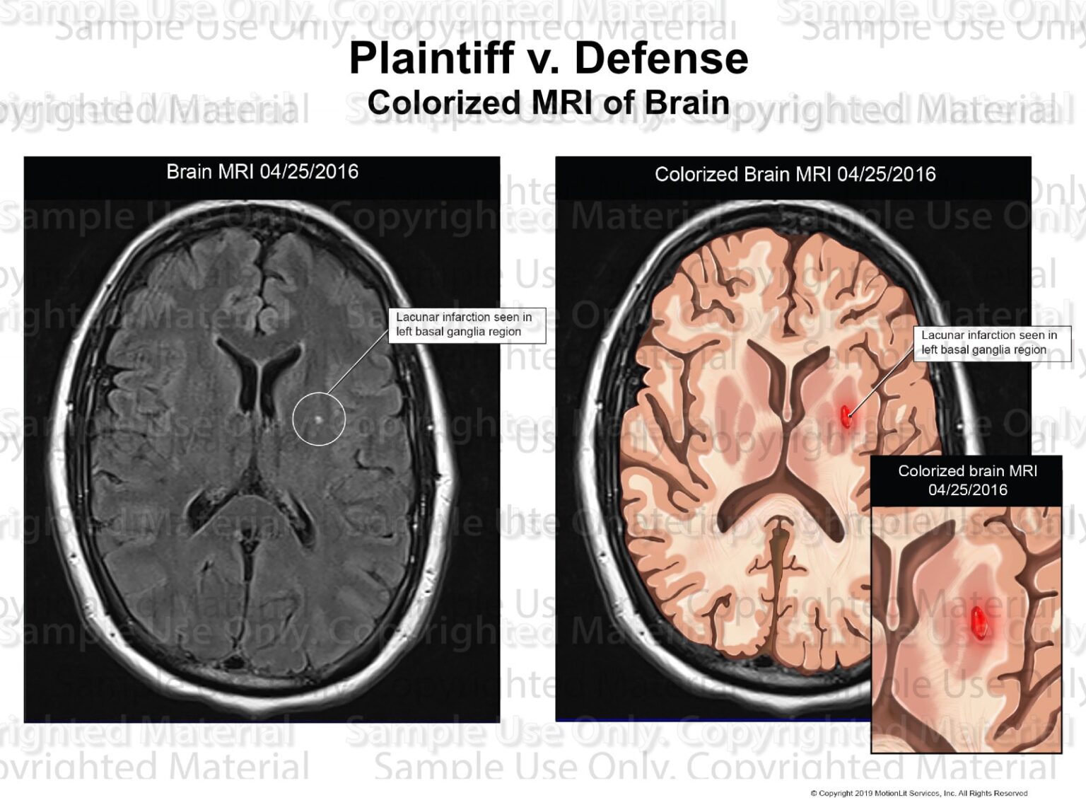 Lacunar Infarct MRI interp - MotionLit