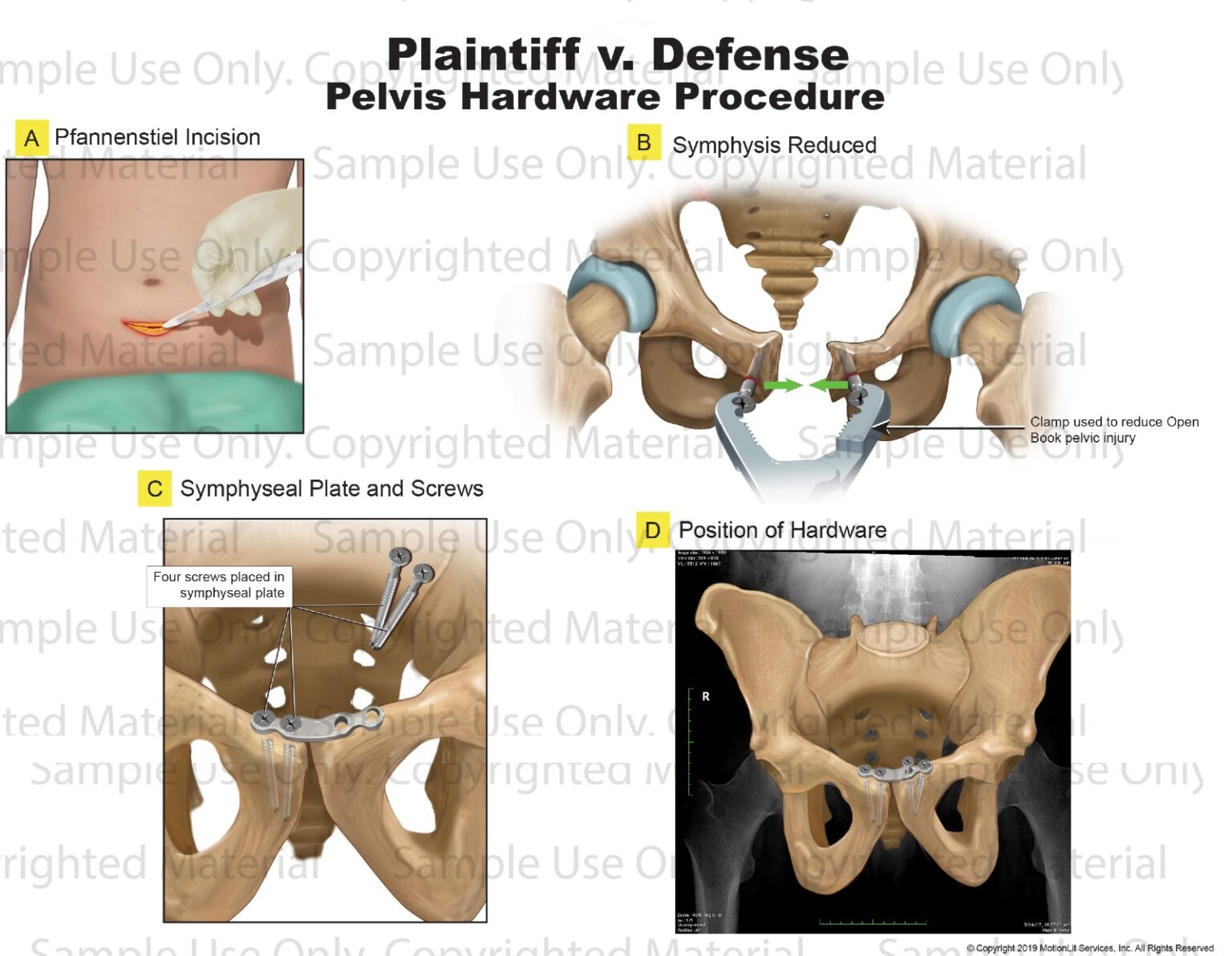 Pelvic Hardware Implant Procedure - MotionLit
