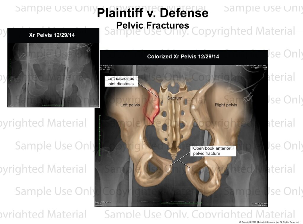 Pelvis Fracture X-ray Interpretation - MotionLit