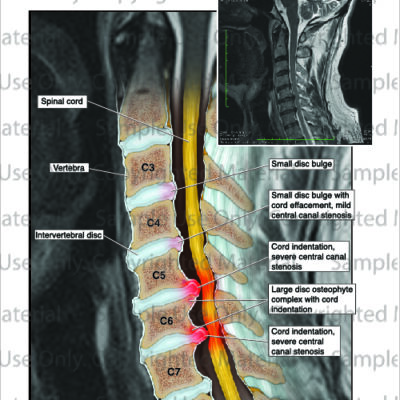 Cervical Disc Protrusions C5-6, C6-7 - MotionLit