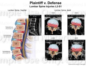 Lumbar Spine Disc Injuries MRI Interpretation L2-S1 - MotionLit