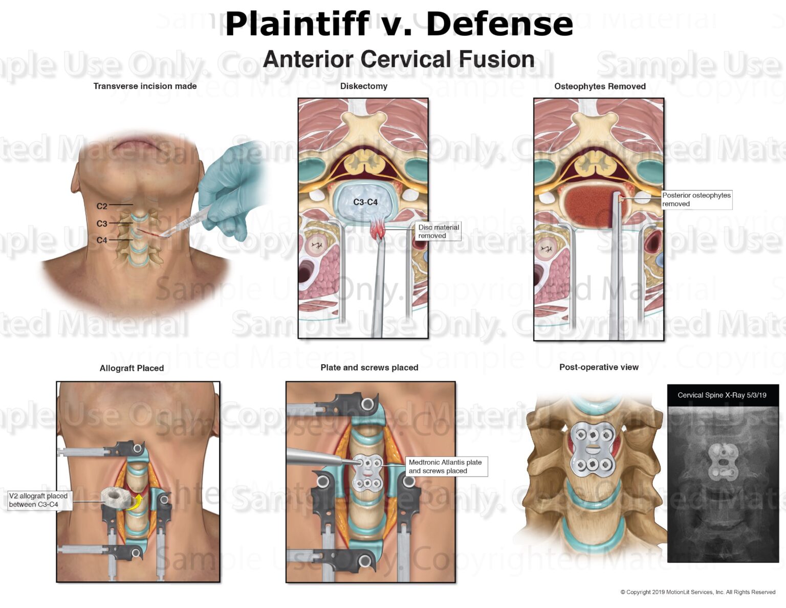 Anterior Cervical Diskectomy Fusion - MotionLit