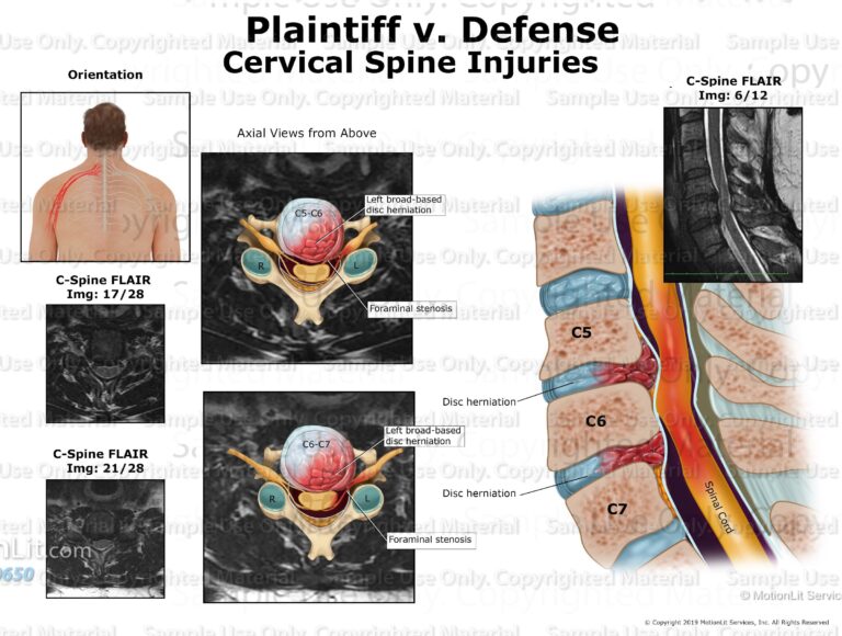 Cervical Spine C5-C7 - MotionLit