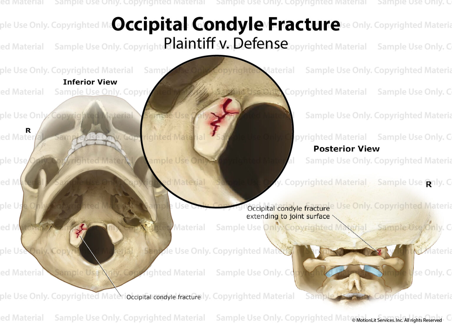 Occipital Condyle Fracture - MotionLit