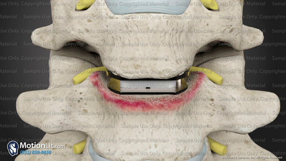 Cervical Disc Replacement C5-C6 - MotionLit
