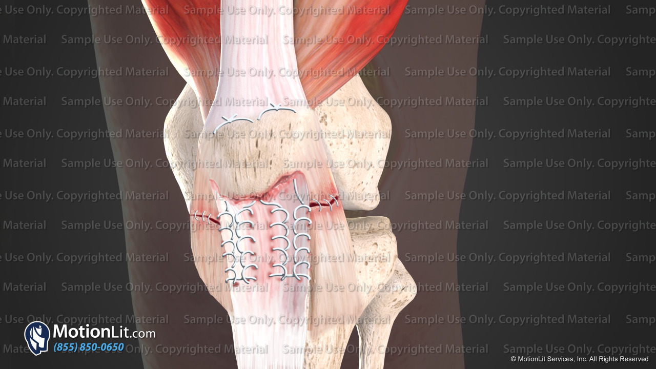 Bilateral Patellar Tendon Repairs - MotionLit