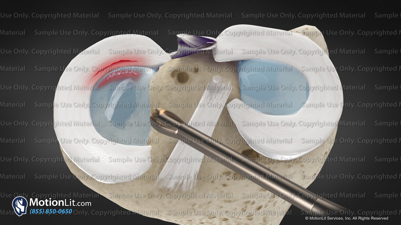 Repair of L Knee & Meniscus Tear - MotionLit