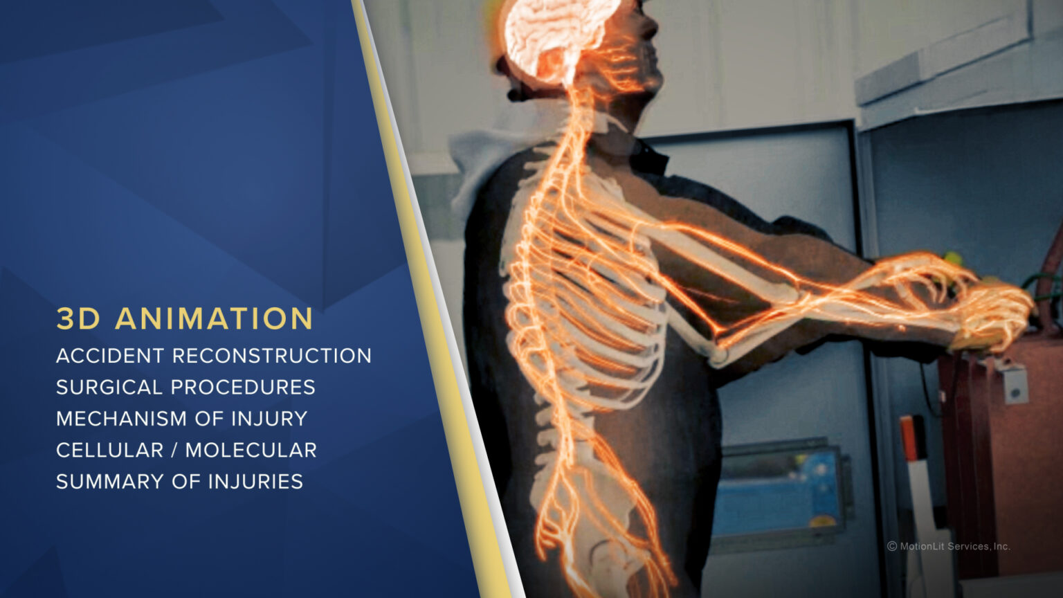 3D Reconstruction Shows Mechanism of Injury In Rear-End Intersection ...